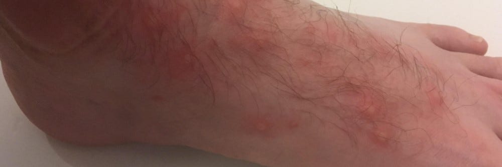 Clover Mites Vs. Chiggers: Difference Between These Pests | Solutions ...