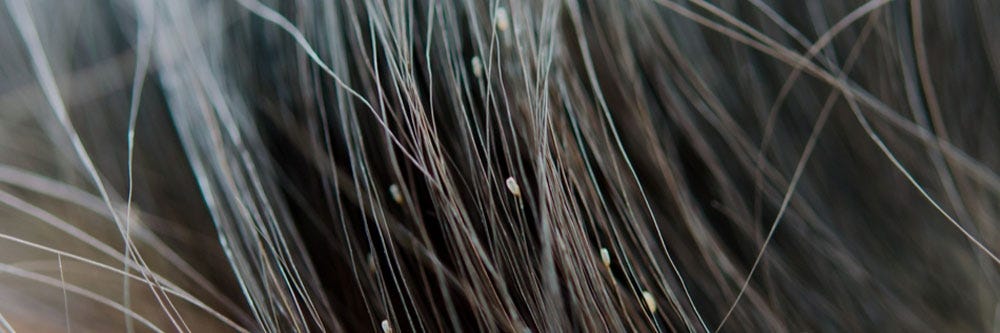 How To Get Rid of Head Lice | DIY Head Lice Control Products ...